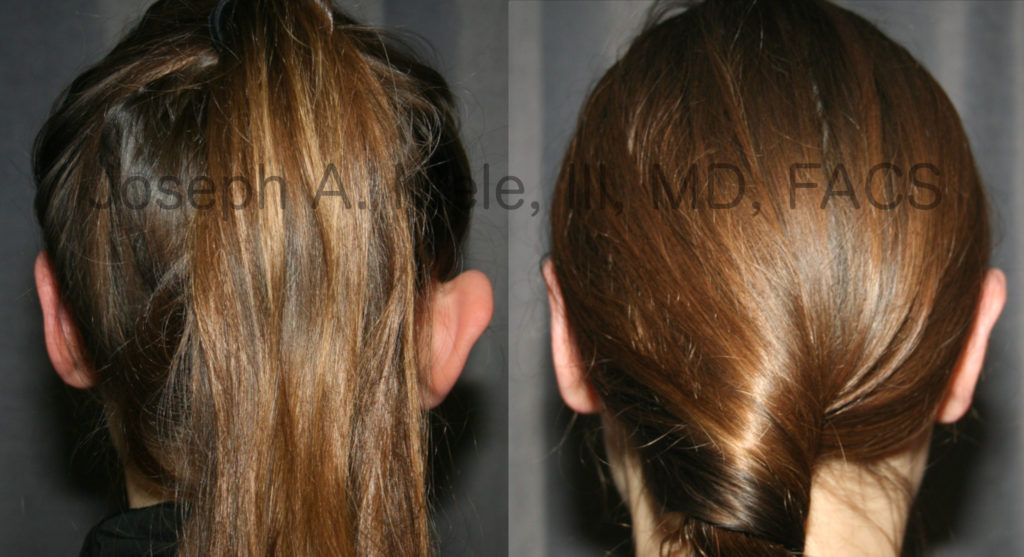 female_otoplasty_with_asymmetry | Dr Mele