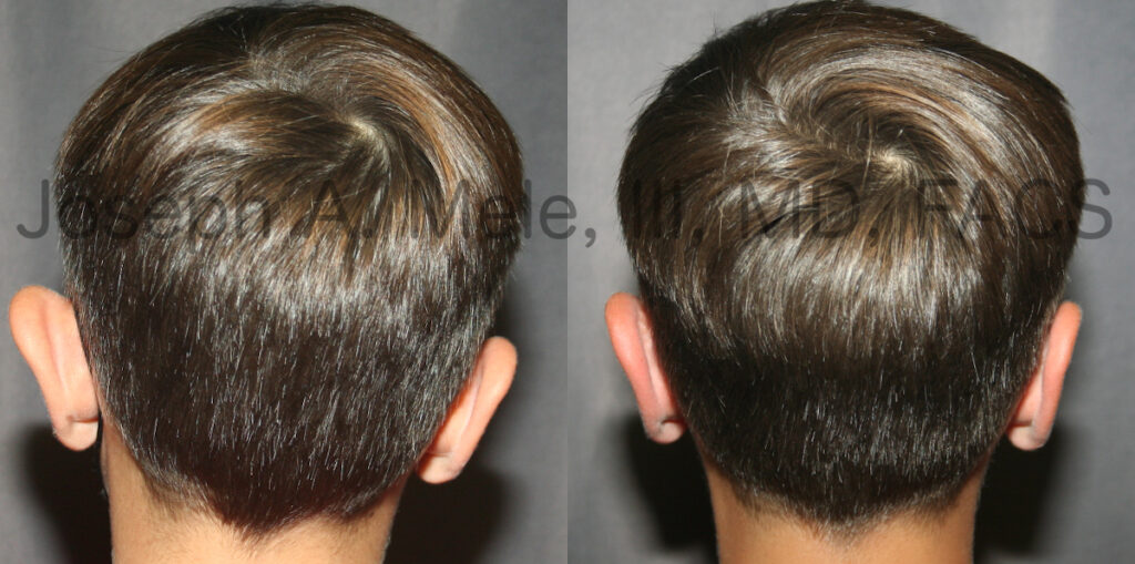 Otoplasty for Prominent Ears