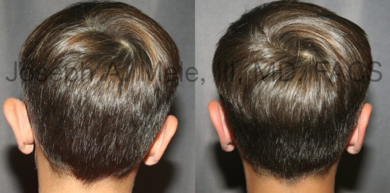 Otoplasty for Prominent Ears