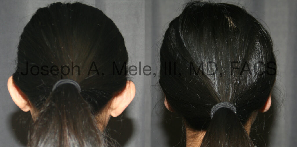 Ear Pinning – Reshaping the Ear