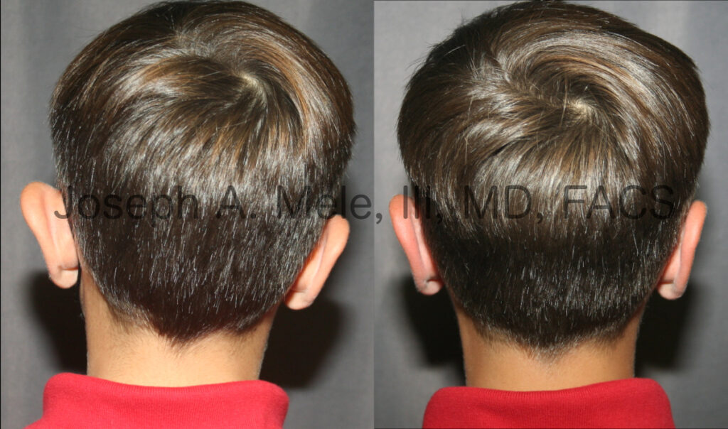 Ear Pinning For Prominent Ears Otoplasty Pearls