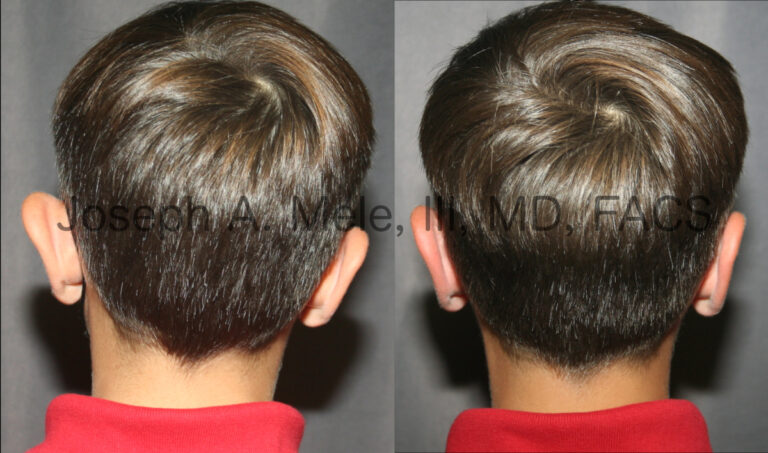 Ear Pinning For Prominent Ears – Otoplasty Pearls