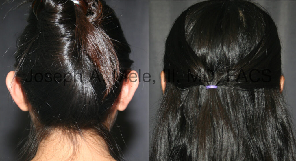 Ear Pinning For Prominent Ears – Otoplasty Pearls