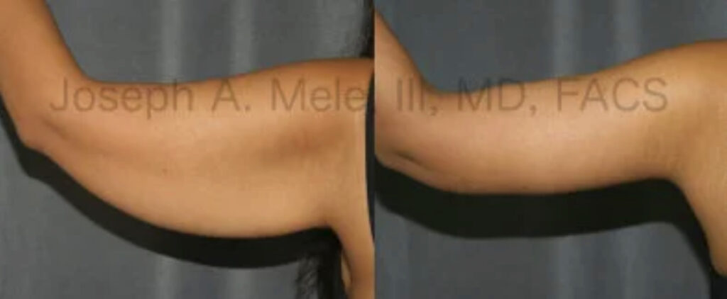 How to do an Arm Lift – Brachioplasty Instructions