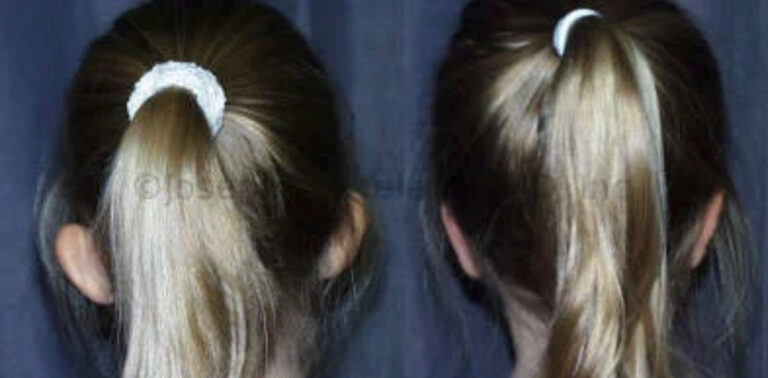Otoplasty – What to Expect When Getting Your Ears Pinned